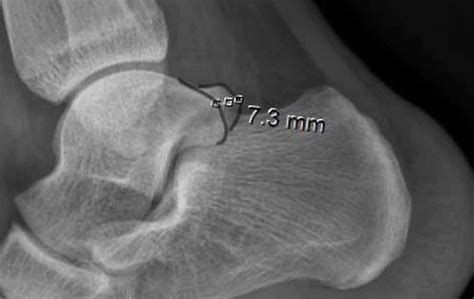 Lateral Radiographs Of The Ankle Showing A Prominent Posterolateral