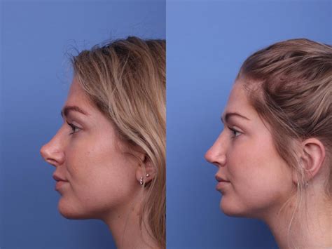 Rhinoplasty Surgery In Turkey Istanbul Nose Job In Turkey