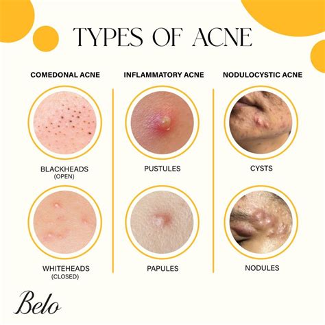 Understanding Acne Common Types And Triggers
