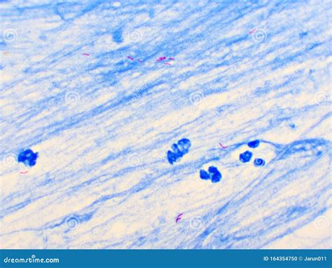 Mycobacterium Tuberculosis Positive In Sputum Smear Stock Image 165320191
