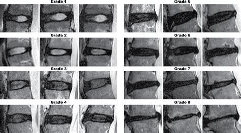 The Modified Pfirrmann Classification For Disc Degeneration Takes Download Scientific Diagram