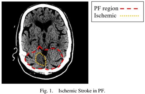 Figure 1 From Deep Transfer Learning Application For Automated Ischemic Classification In