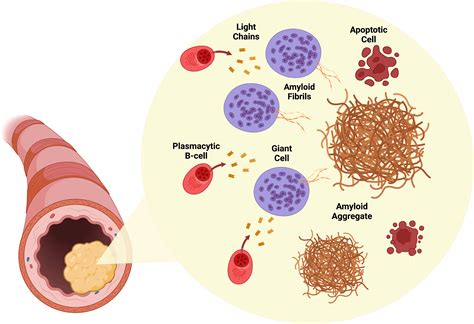 Frontiers Localized Light Chain Amyloidosis A Self Limited Plasmacytic B Cell