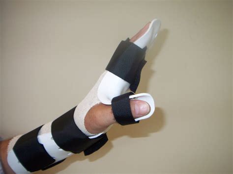 Finger Splint Dynamic Vs Static Sadebafreaks
