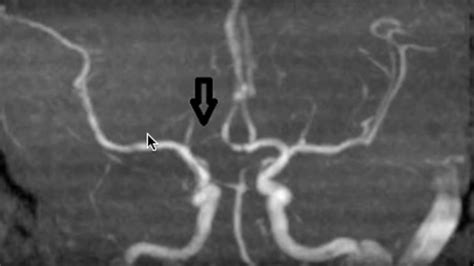 How To Diagnose A1 Segment Hypoplasia In Mri Youtube