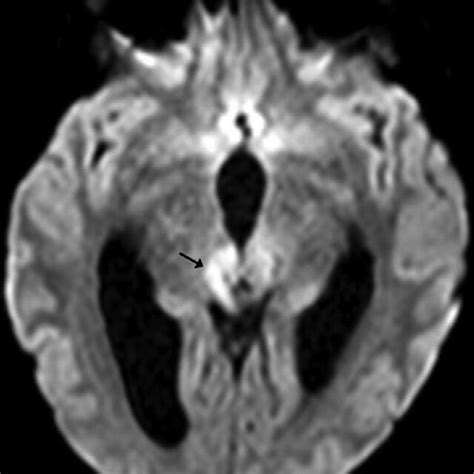 Axial Diffusion Weighted Imaging DWI 1 5 T TR TE 6300 89 0 Ms