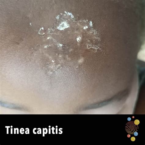 Tinea Capitis Skin Deep