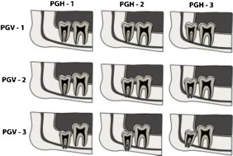 The Effect Of First And Second Premolar Extractions On Third Molars A Retrospective