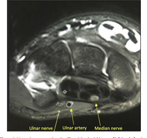 Figure 2 From Dynamic Nerve Compression Of Guyon Canal Secondary To Variation Of The Deep Branch