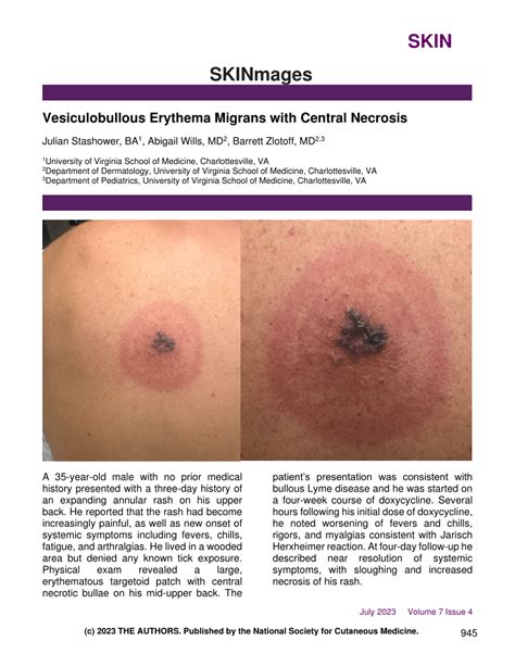 Pdf Vesiculobullous Erythema Migrans With Central Necrosis