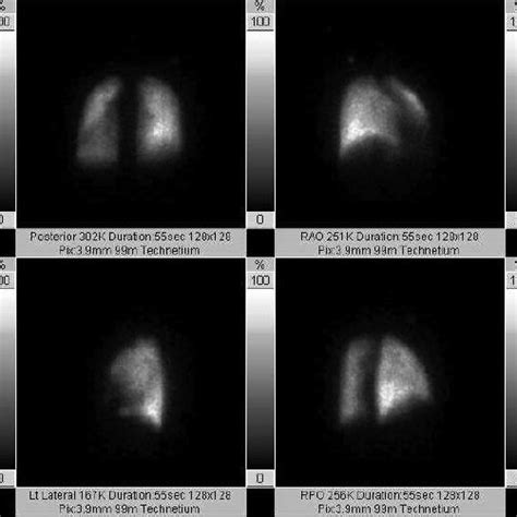 Lung Perfusion Scan Showed Segmental Perfusion Defects Were Detected In Download Scientific