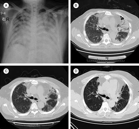 A Chest X Ray At Admission Showed Diffuse Inflammation And Fibrosis Download Scientific