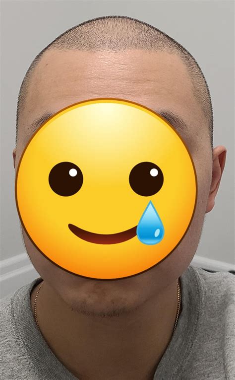 Getting Smp With Existing Hair Rhairtransplants