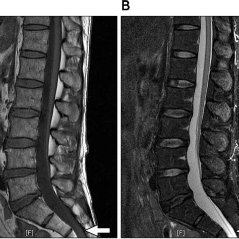 Contrast Dye Injection To The Introducer Needle Showed A Myelogram In Download Scientific