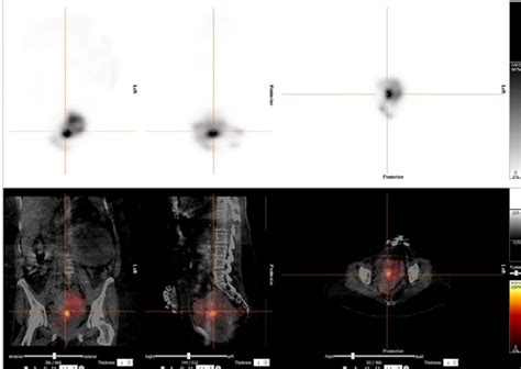 Nuclear Medicine CT SPECT Scan Of 62 Year Old Female Was Done Two Download Scientific Diagram