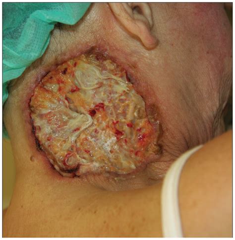 Early Pyoderma Gangrenosum