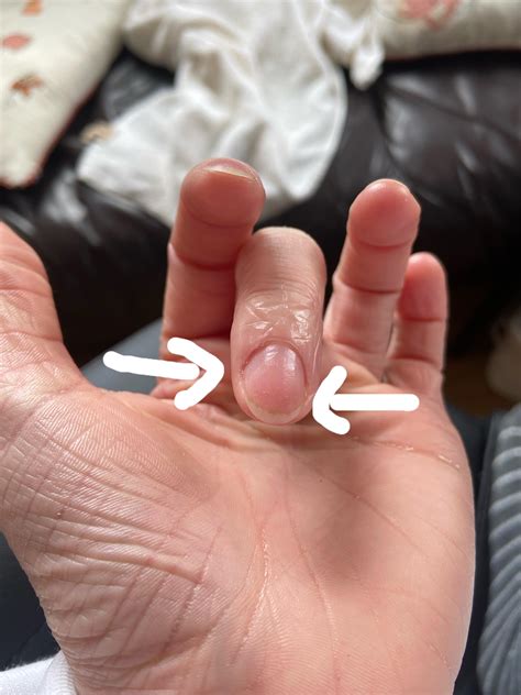 Lateral Nail Fold Rnails