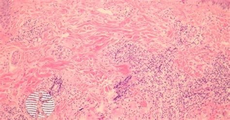 Annular Elastolytic Giant Cell Granuloma Pathology Image