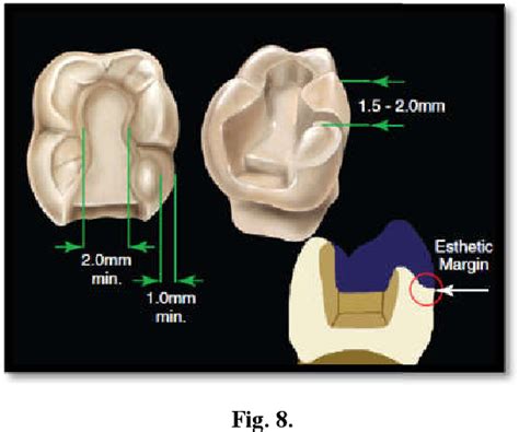Onlay Preparation Techniques Semantic Scholar
