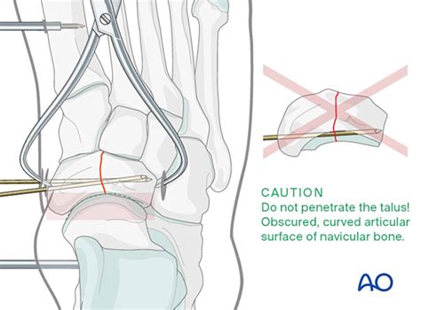 Lag Screw Fixation For Complete Articular Navicular Fracture