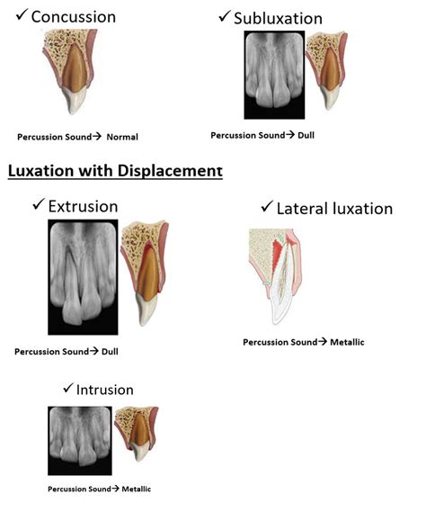 Tooth Fracturecracked Tooth Causes Diagnosis And Treatments