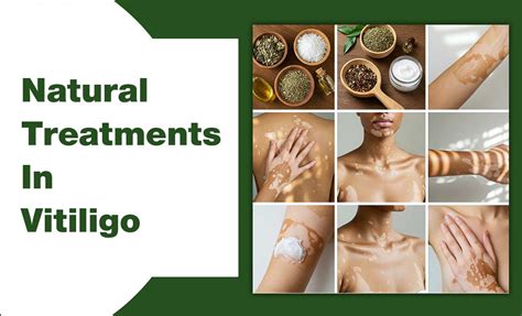 Natural Vitiligo Treatments Diy Remedies For Skin