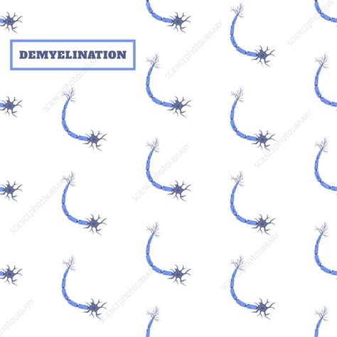 Demyelination Conceptual Illustration Stock Image F044 2279 Science Photo Library