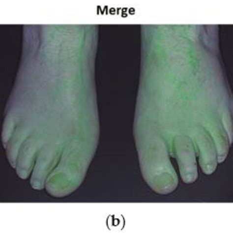 Icg Nir Fluorescence Imaging In A Control Patient Showing The Visual Download Scientific