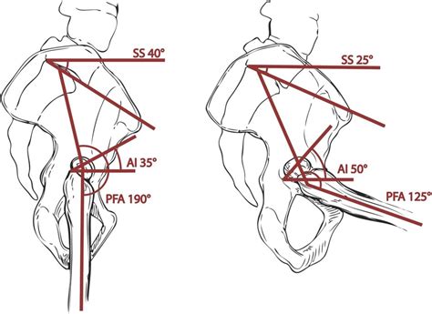 Fernando Flores On Linkedin Late Dislocation Following Total Hip