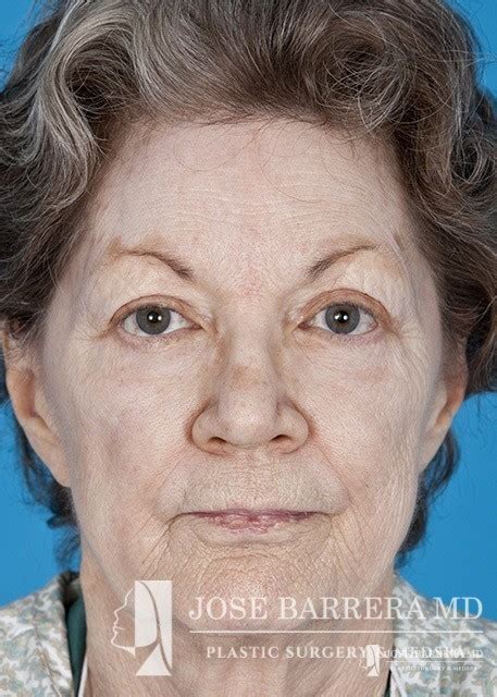 Blepharoplasty Case 12358 Dr Jose Barrera San Antonio Facial Plastic Surgeon And Ent