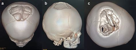 At 19 Months Old Three Dimensional Ctparietal Bone Defects Measuring