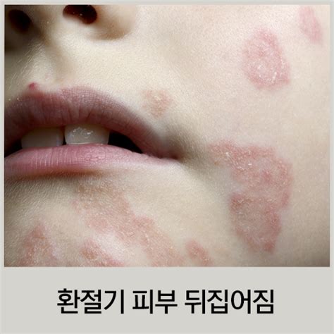환절기 피부 뒤집어짐 회복하는 방법 네이버 블로그