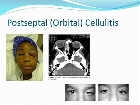 Ppt Eent Infections Powerpoint Presentation Free Download Id 3686632