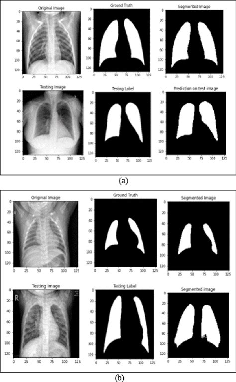 Figure From Lung Chest X Ray Image Segmentation For Detection Of Pneumonia Using Convolutional