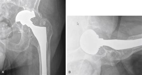 Acetabular Reconstruction With A Jumbo Socket Clinical Tree