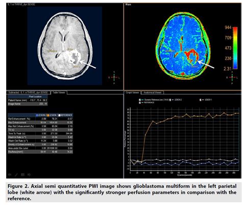 Clinical Approach Of Perfusion Weighted Imaging