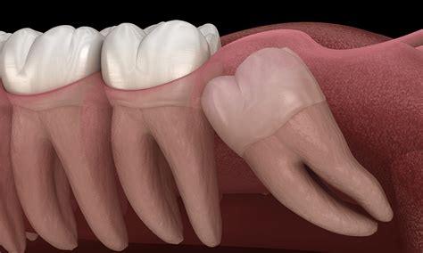 Wisdom Tooth Removal Cost Omega Dental Houston Tx
