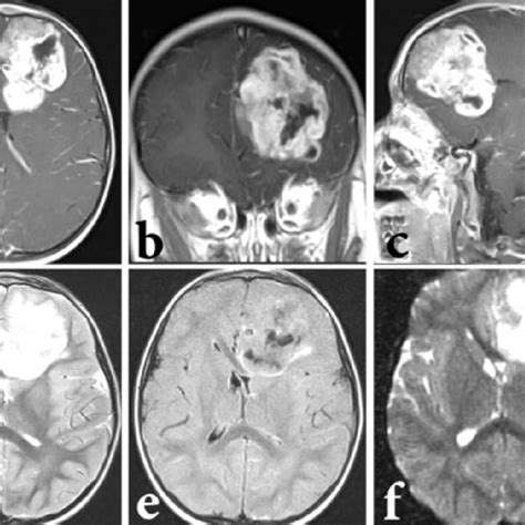 Mri A Axial T1 Weighted With Gadolinium Enhancement Large