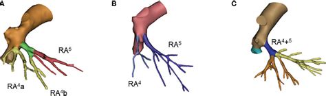 Figure 1 From An Atlas Of Anatomical Variants Of Subsegmental Pulmonary Arteries And Recognition