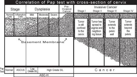 Pap Smear Gynecology Medbullets Step 2 3