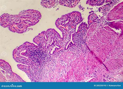 Chronic Cholecystitis Light Micrograph Stock Image 122813083