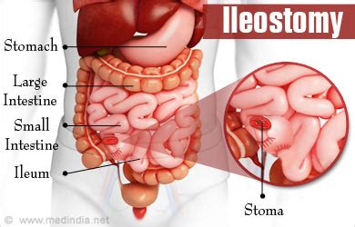 Ileostomy Diagram