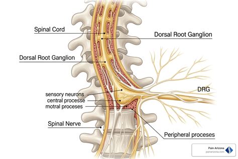 Dorsal Root Ganglion Breakthrough 70 Pain Relief