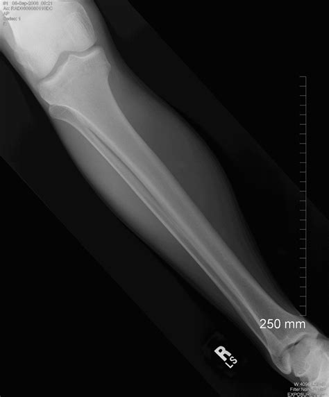 Tib Fib Anatomy Diagram Quizlet