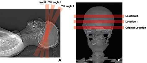 Peak Skin And Eye Lens Radiation Dose From Brain Perfusion Ct Based On