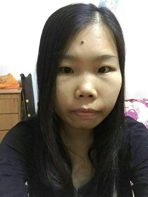 地中海贫血人长相图片 贫血面容 伤感说说吧