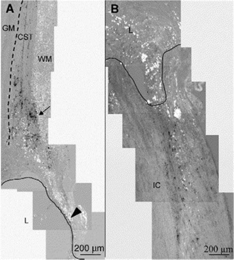 Corticospinal And Ascending Sensory Tract Tracing At 12 Weeks