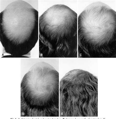 Androgenic Hair