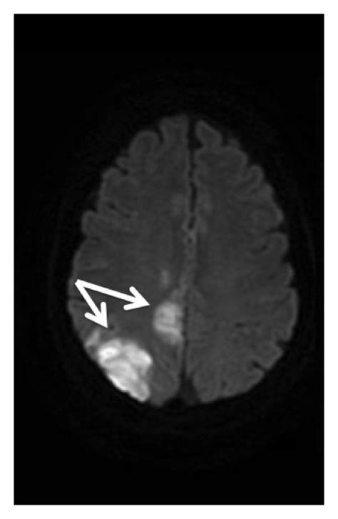 Diffusion Weighted Imaging A And Fluid Attenuated Inversion Recovery Download Scientific