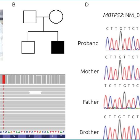 Clinical And Genetic Data Of A Patient With Ichthyosis Follicularis